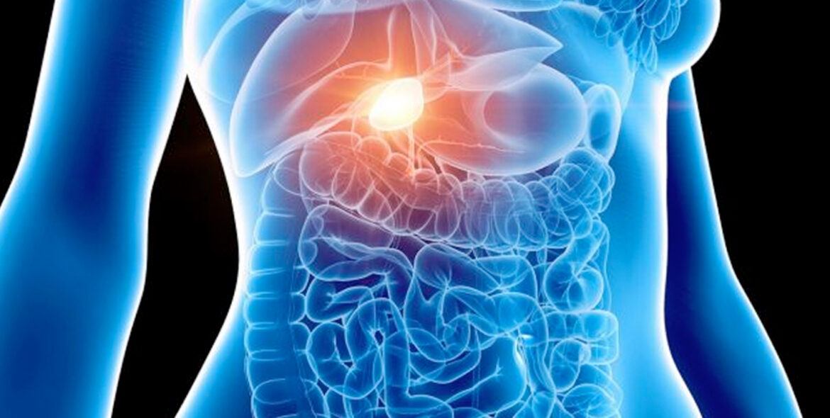 Cálculo biliar (pedra na vesícula), o que é? – Dr. Tulio Assis